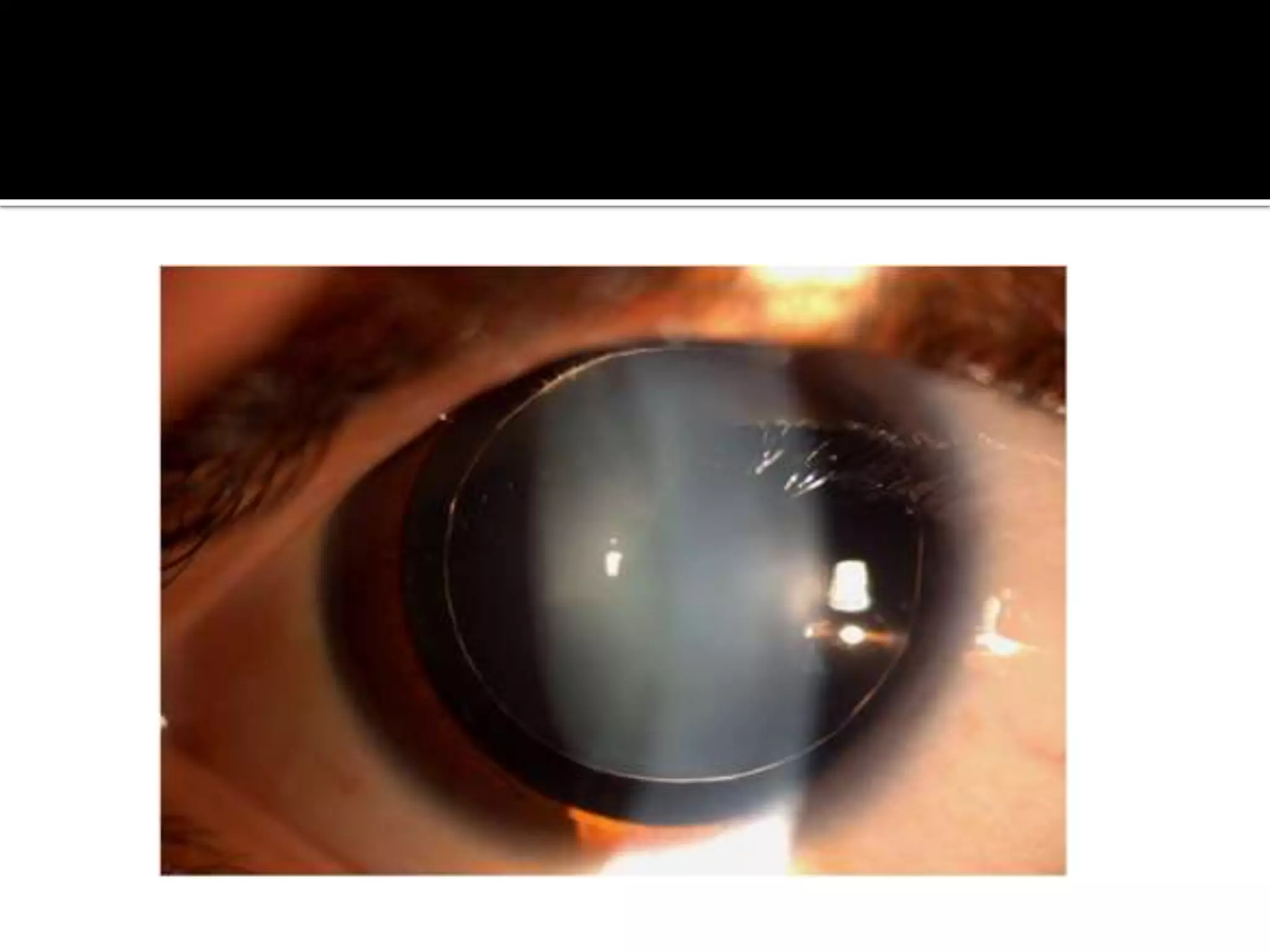 Lenticular abnormalities | PPTX