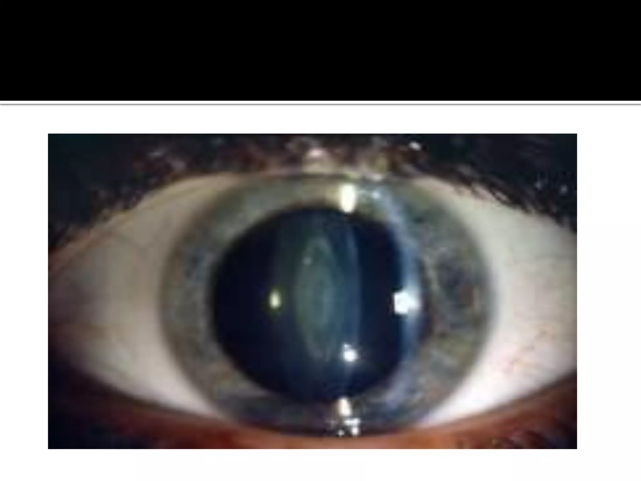 Lenticular abnormalities | PPTX