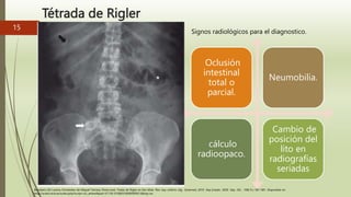 Íleo Biliar ............................ | PPTX