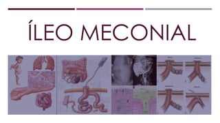 Íleo meconial | PPTX