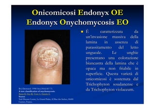 Le onicopatie. prevenzione, diagnosi differenziale e trattamento | PDF