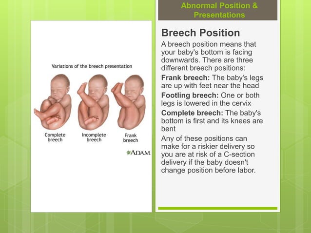 Leopold’s Maneuver