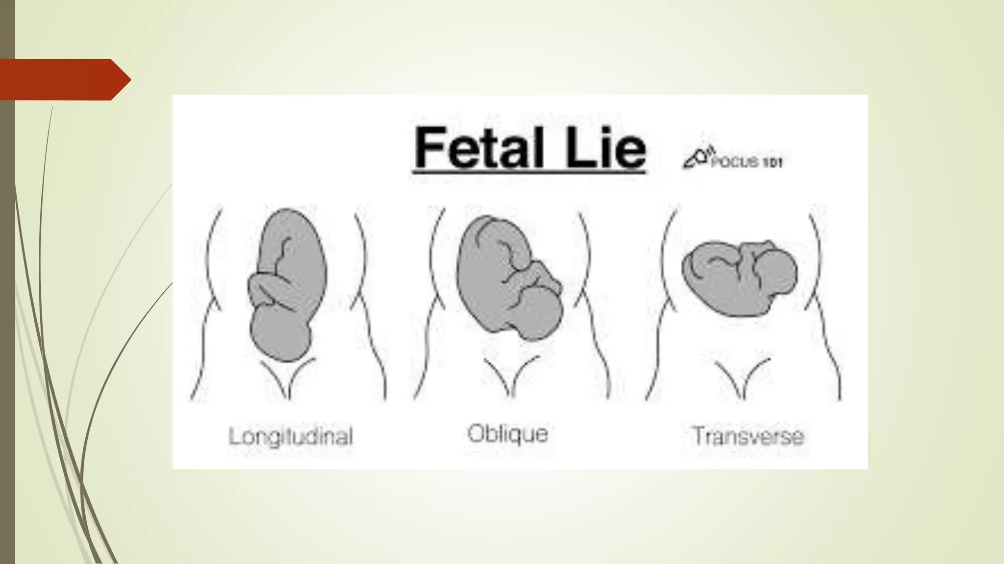 LEOPOLD'S MANEUVER.pptx