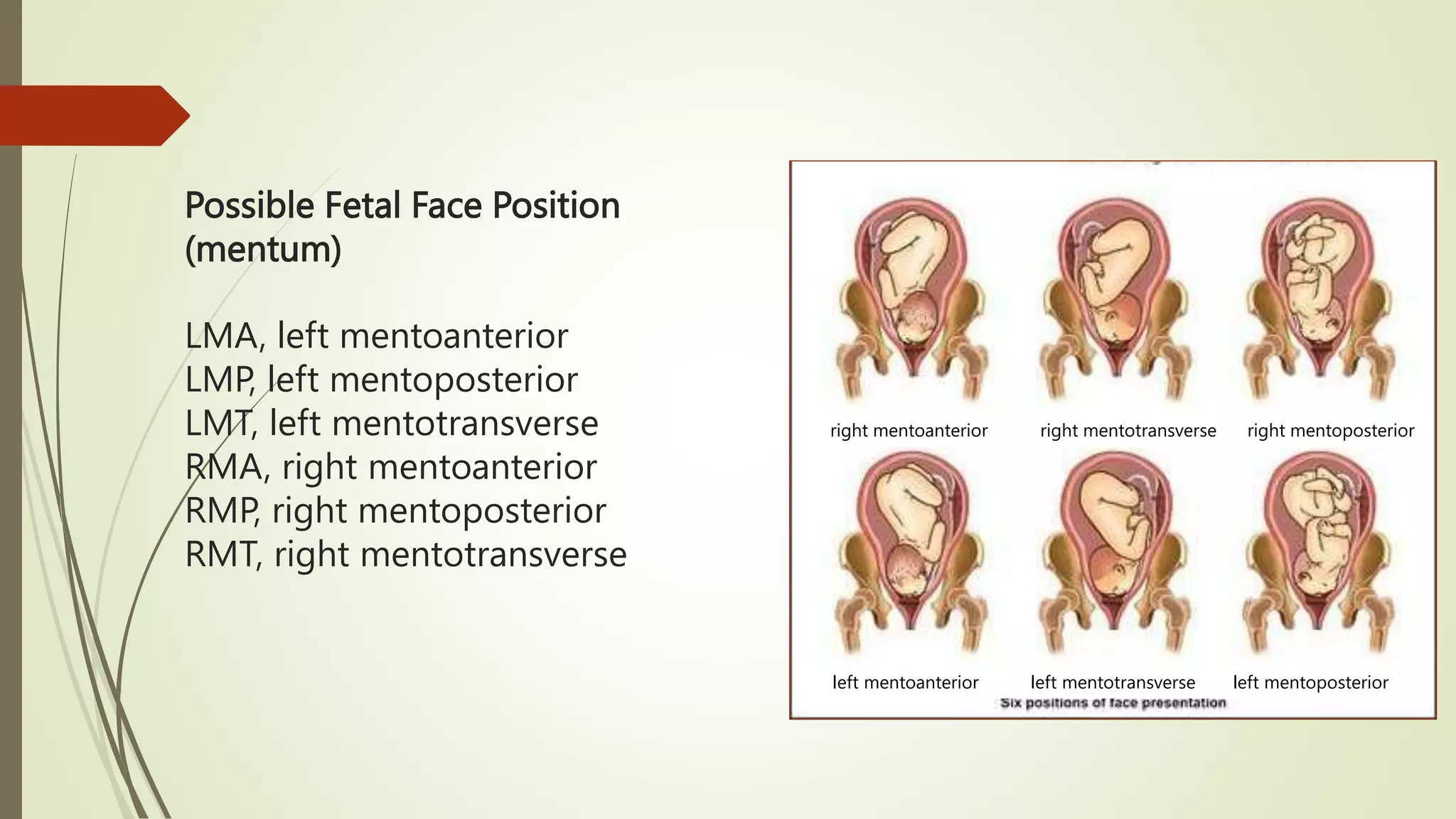 LEOPOLD'S MANEUVER.pptx