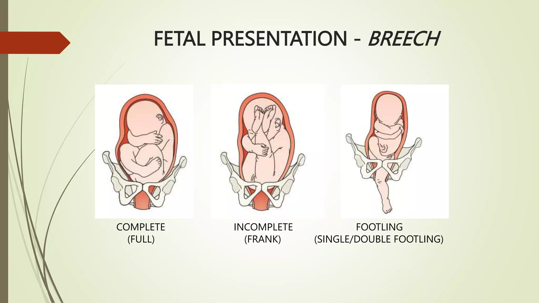 LEOPOLD'S MANEUVER.pptx