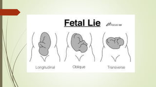 LEOPOLD'S MANEUVER.pptx