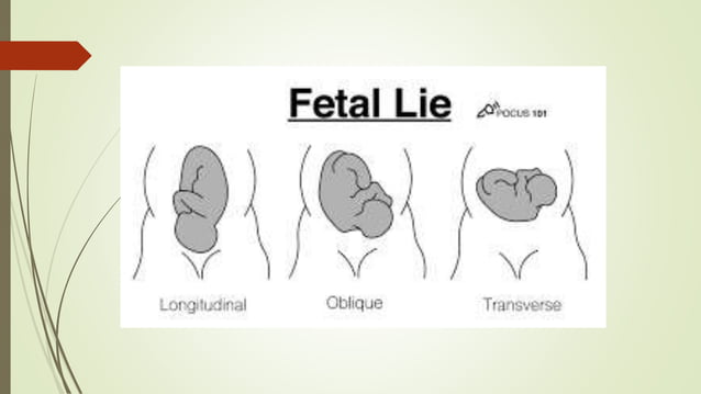 LEOPOLD'S MANEUVER.pptx | Pregnancy | Reproductive Health