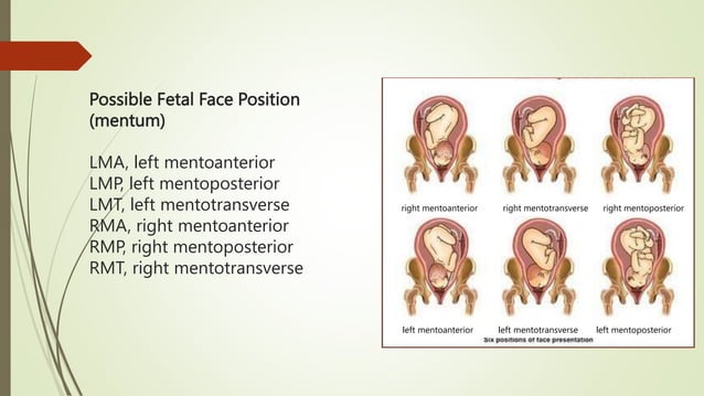 LEOPOLD'S MANEUVER.pptx | Pregnancy | Reproductive Health