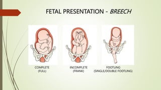 LEOPOLD'S MANEUVER.pptx