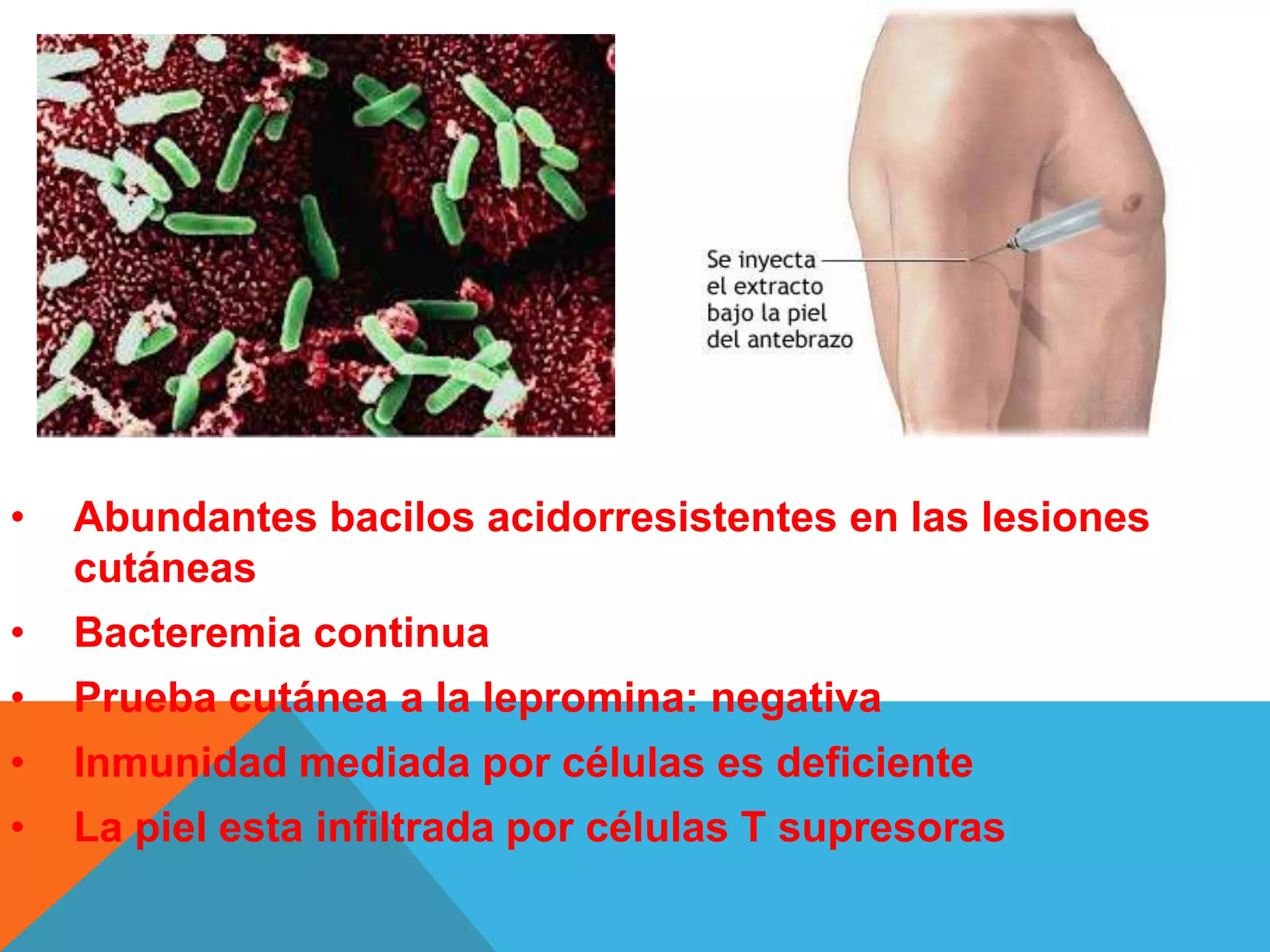 Lepra | PPTX