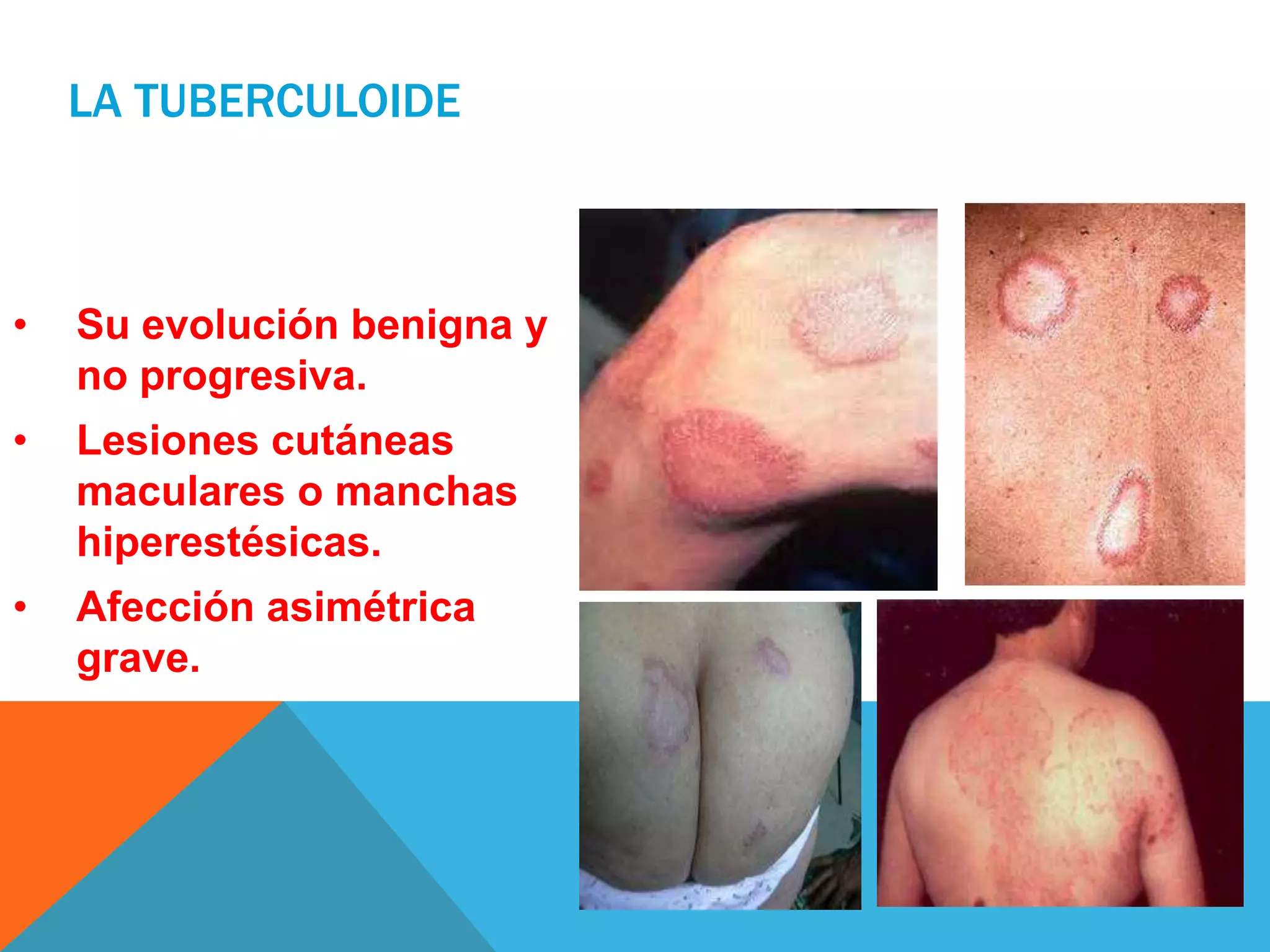 Lepra | PPTX