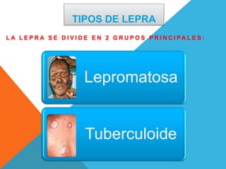 Lepra | PPTX
