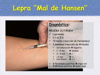 Lepra | PPTX