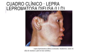 Lepra | PPTX