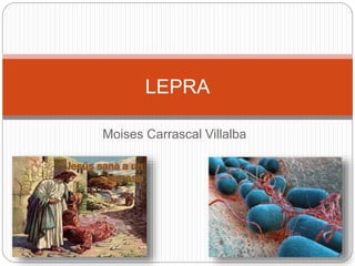 Lepra | PPTX | Skin and Dermatology | Diseases and Conditions