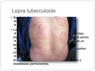 Lepra | PPTX