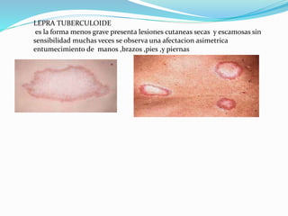 Lepra | PPTX