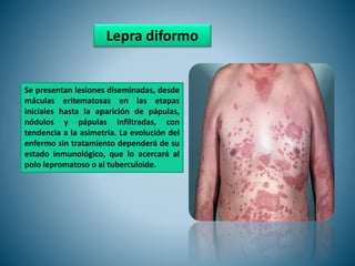 Lepra | PPTX