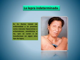 Lepra | PPTX