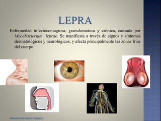 Lepra | PPTX