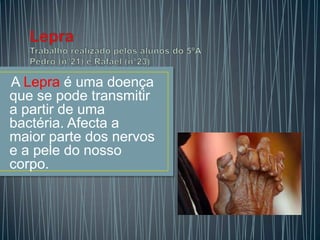 Lepra | PPTX
