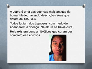 Lepra | PPTX