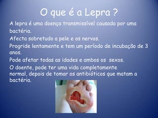 Lepra | PPTX