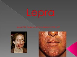 Lepra | PPTX