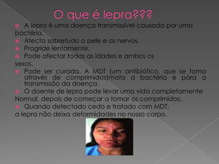 Lepra | PPTX