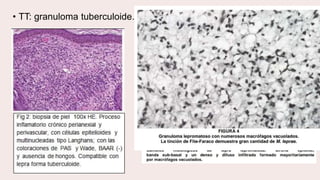 Lepra - Dermatologia_.pptx