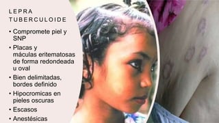 Lepra - Dermatologia_.pptx
