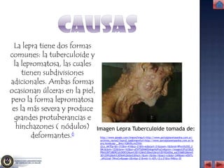LEPRA (ENFERMEDAD DE HANSEN) | PPTX