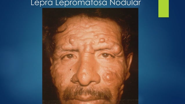 La lepra, también conocida como enfermedad de Hansen, es una enfermedad ...