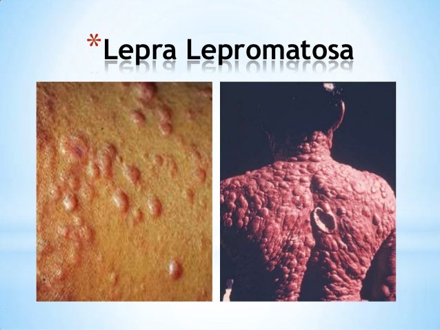 Lepra