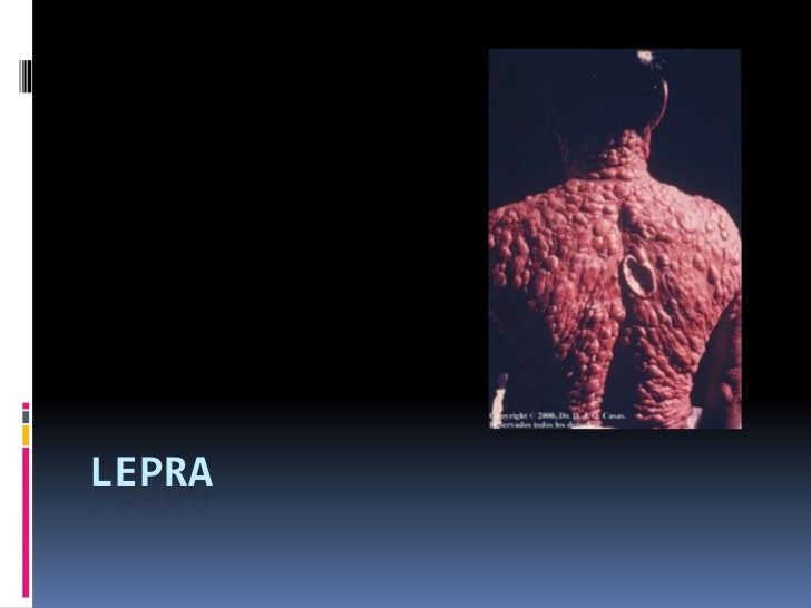 Lepra