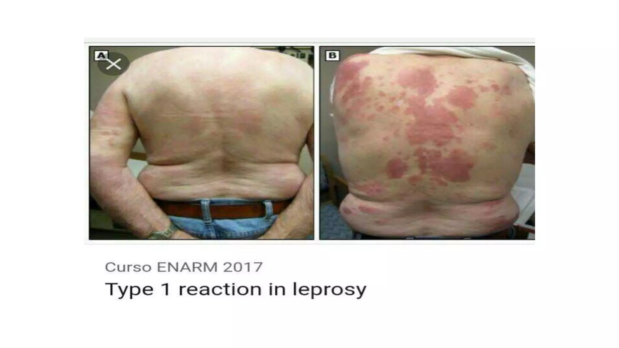 Lepra reactions | PPTX