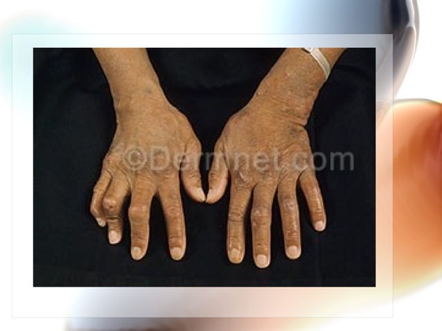 Leprosy | PPT | Infectious Diseases | Diseases and Conditions