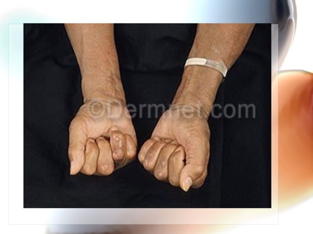 Leprosy | PPT | Infectious Diseases | Diseases and Conditions