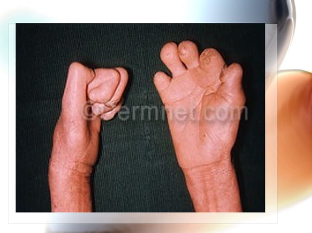 Leprosy | PPT | Infectious Diseases | Diseases and Conditions