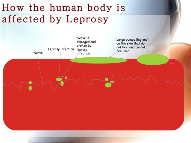 Leprosy | PPT | Infectious Diseases | Diseases and Conditions