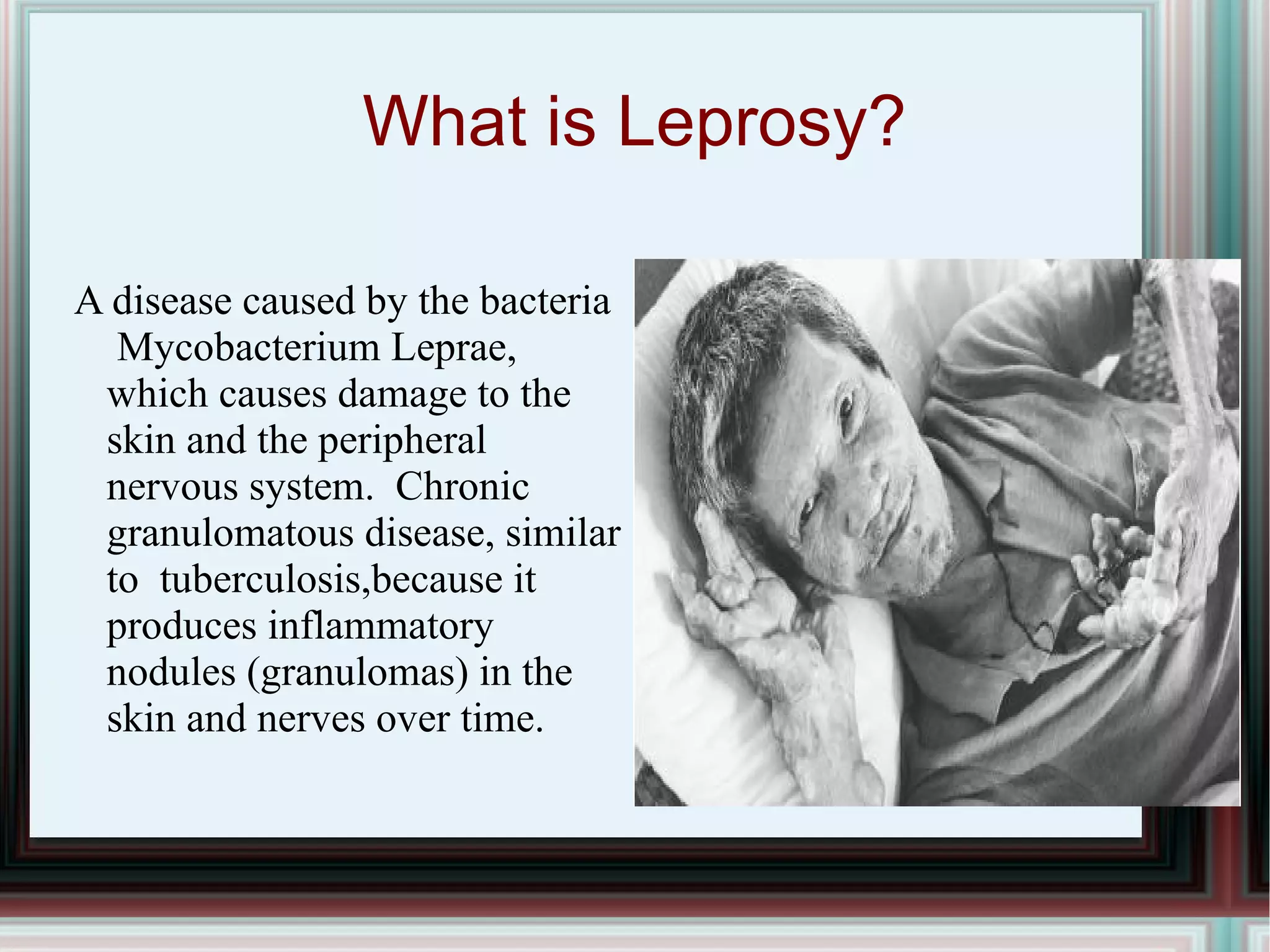 Leprosy | PPT
