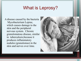 Leprosy | PPT