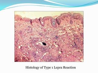 Leprosy | PPTX