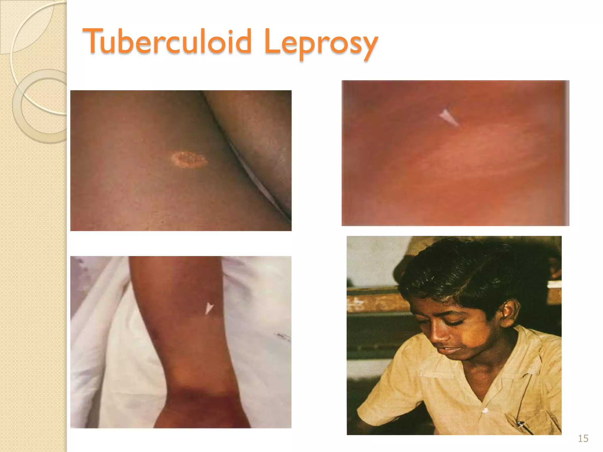Pathophysiology of Leprosy | PDF