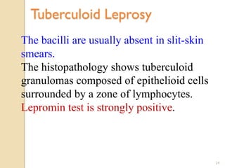 Pathophysiology of Leprosy | PDF