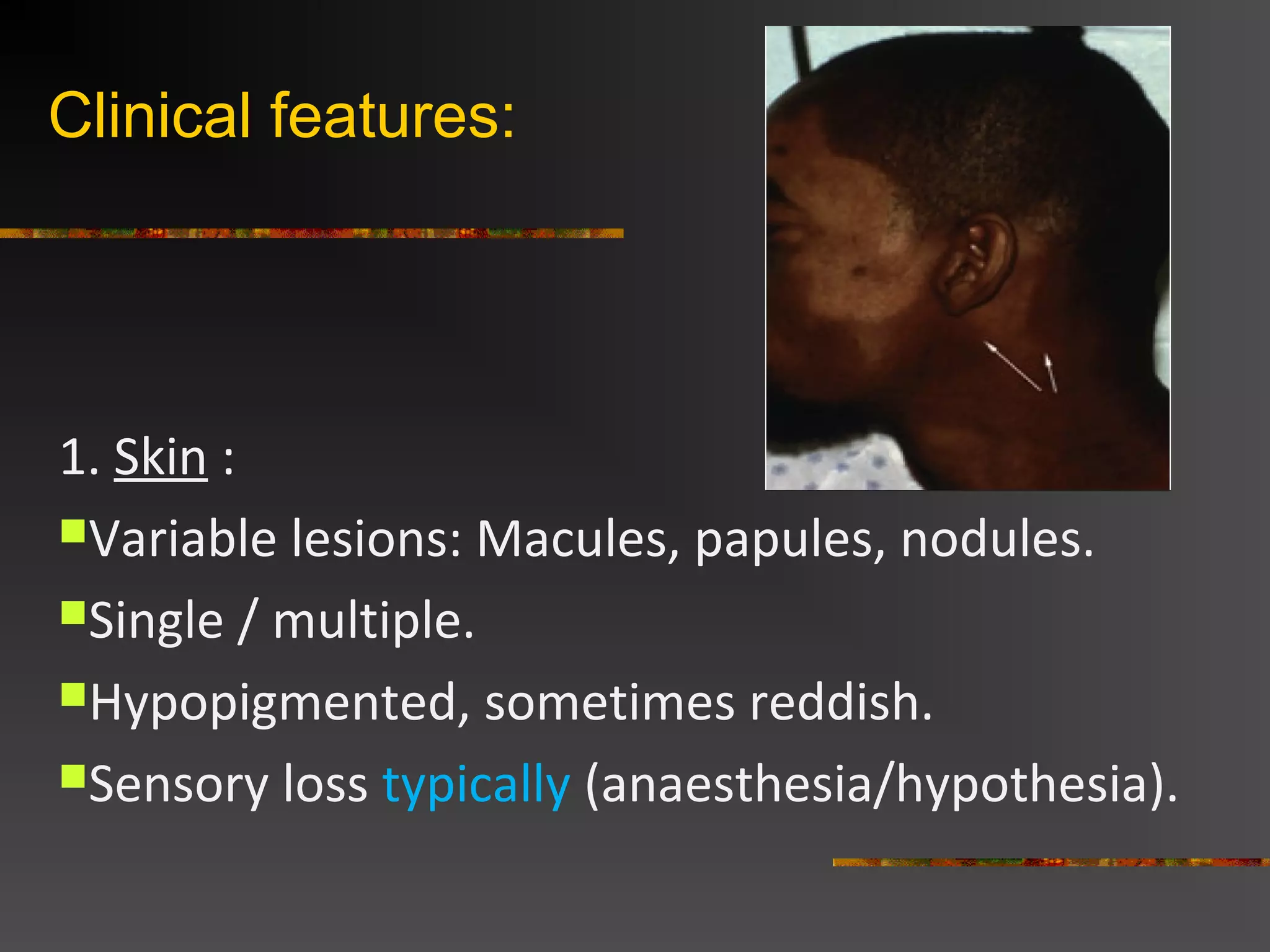 Leprosy | PPT