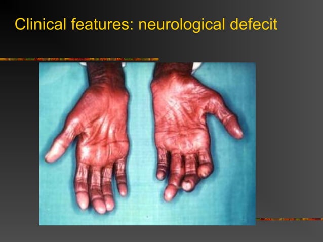 Leprosy | PPT | Infectious Diseases | Diseases and Conditions