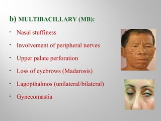 Leprosy | PPT