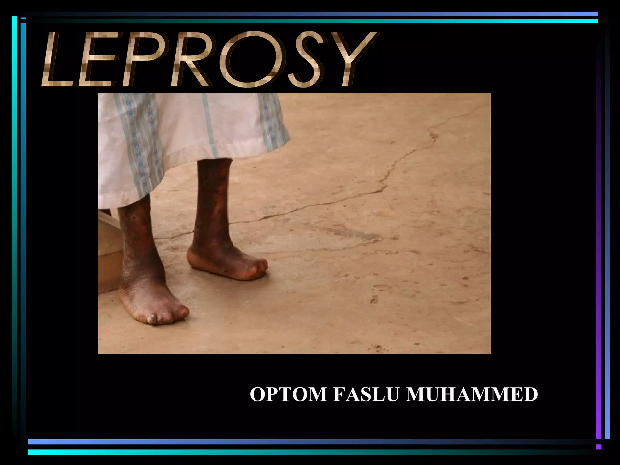Leprosy | PPT