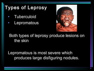 Leprosy | PPT